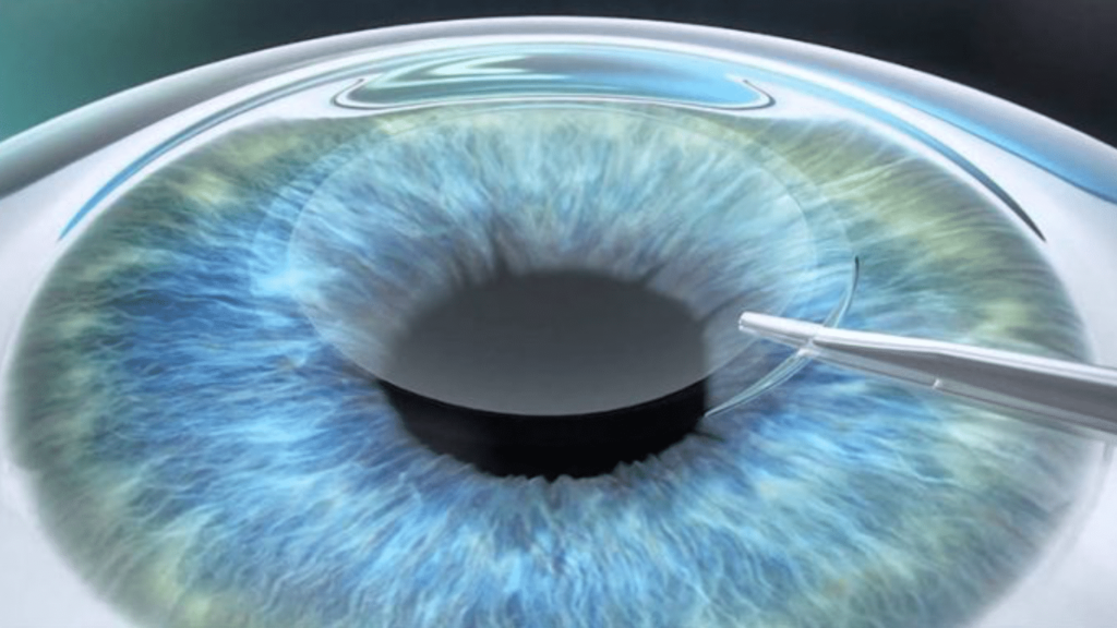 Implant phakes Tunisie : prix chirurgie implant phake ICL